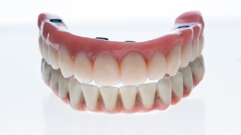 Puche Dental Lab - Guards, Implants Restoration, Dentures