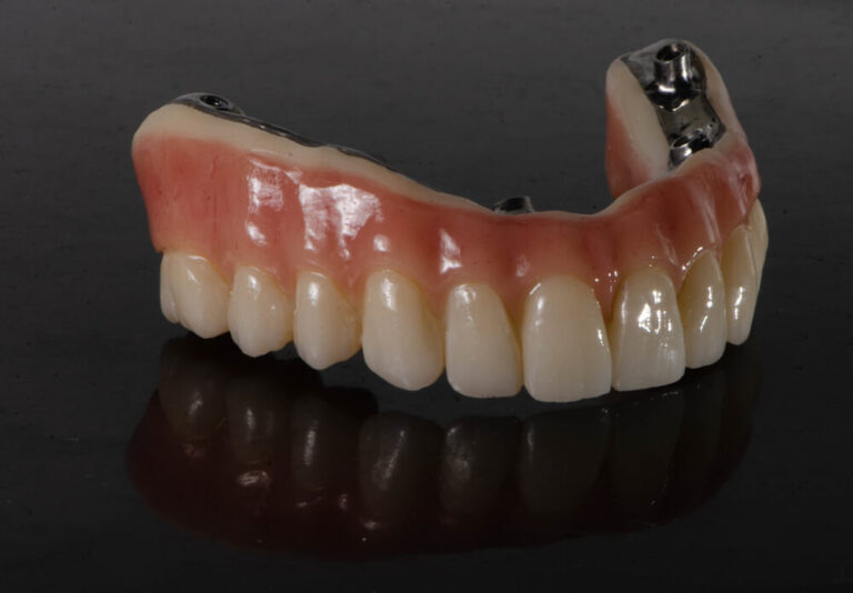 All-on-Four Hybrid Dental Implants